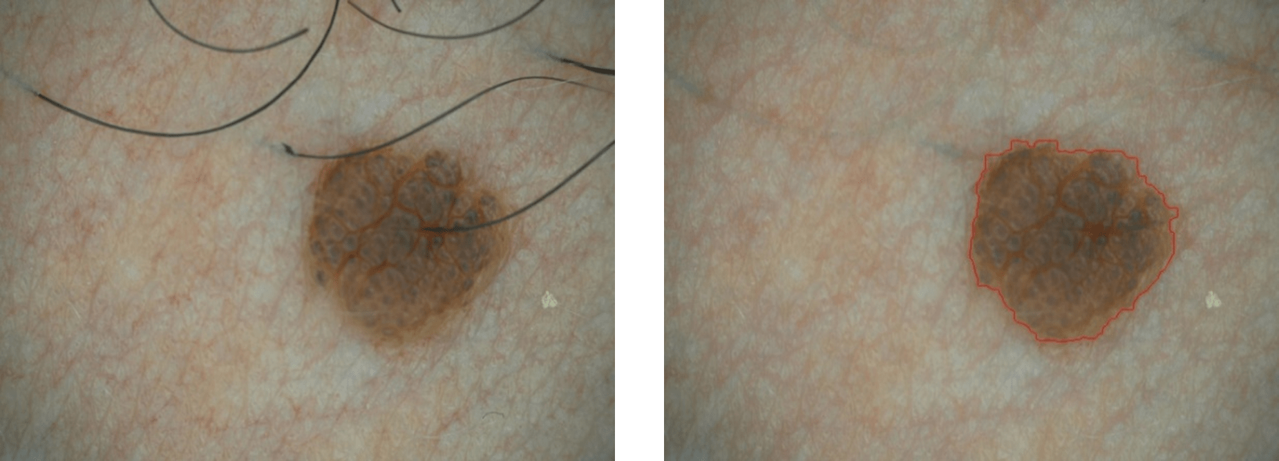 Polarized dermatoscope: OptoSkin - Optosonus
